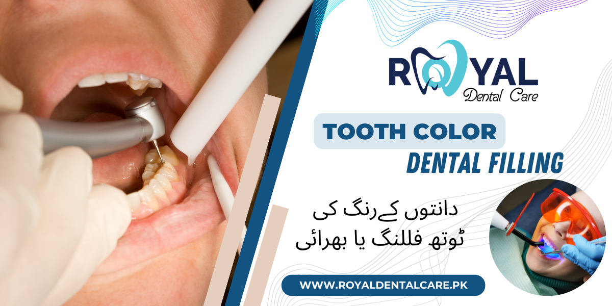 Tooth-colored dental filling - Royal Dental Care