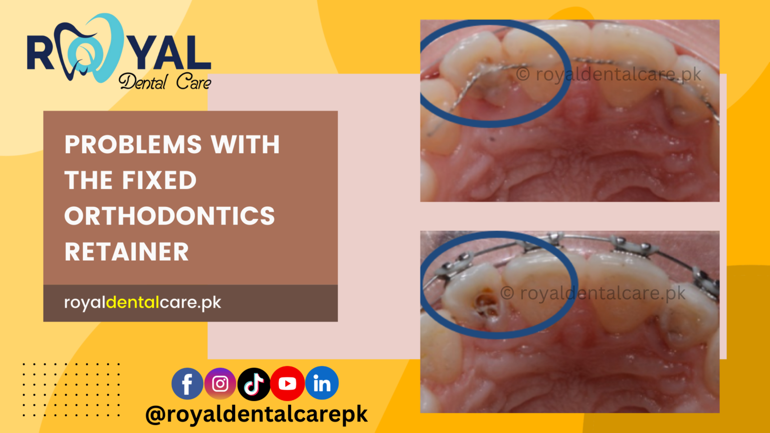 Problems with the fixed orthodontics retainer - Royal Dental Care